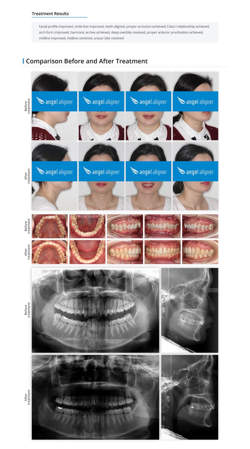 Case Study – Angel Aligner