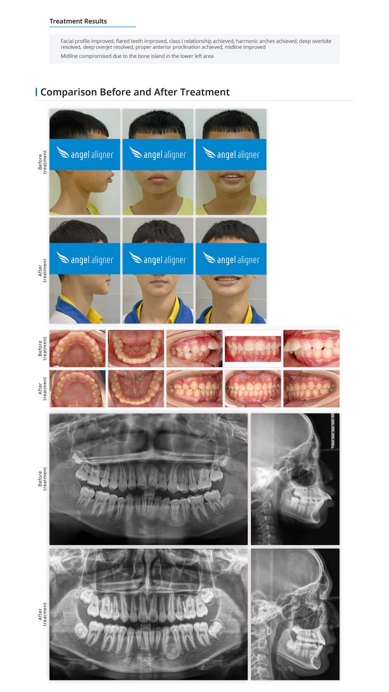 Case Study – Angel Aligner
