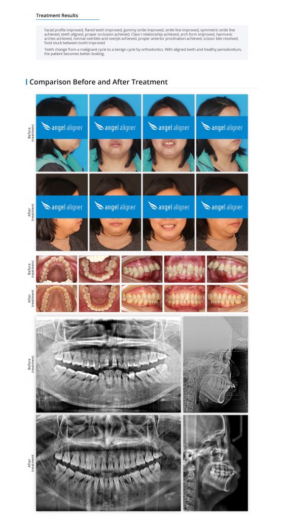 Case Study – Angel Aligner