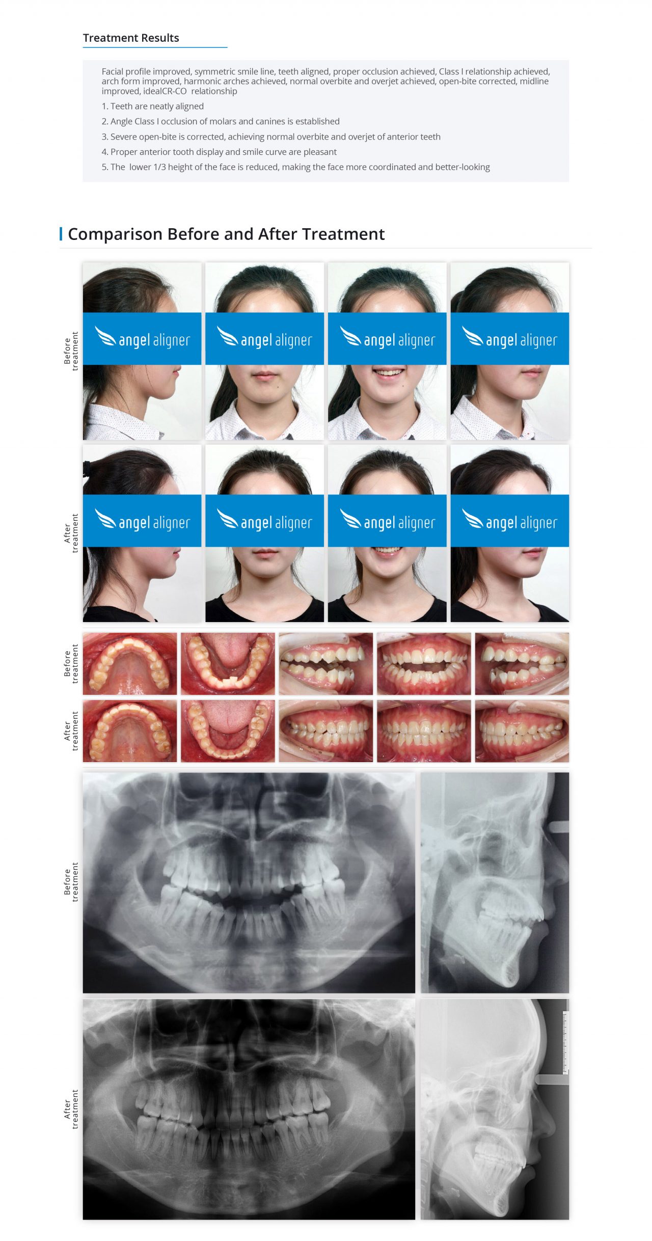 Case Study – Angel Aligner