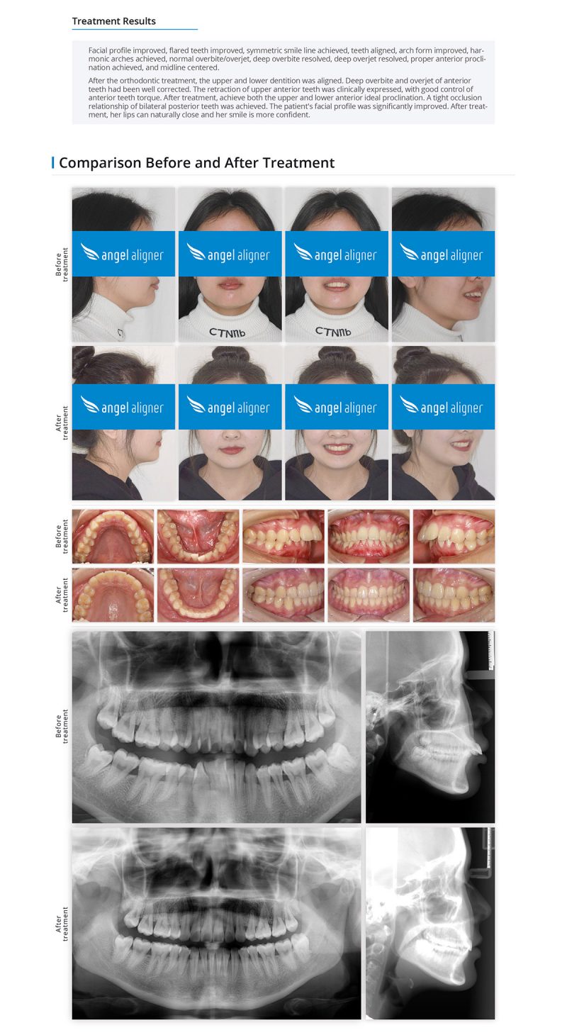 Case Study – Angel Aligner