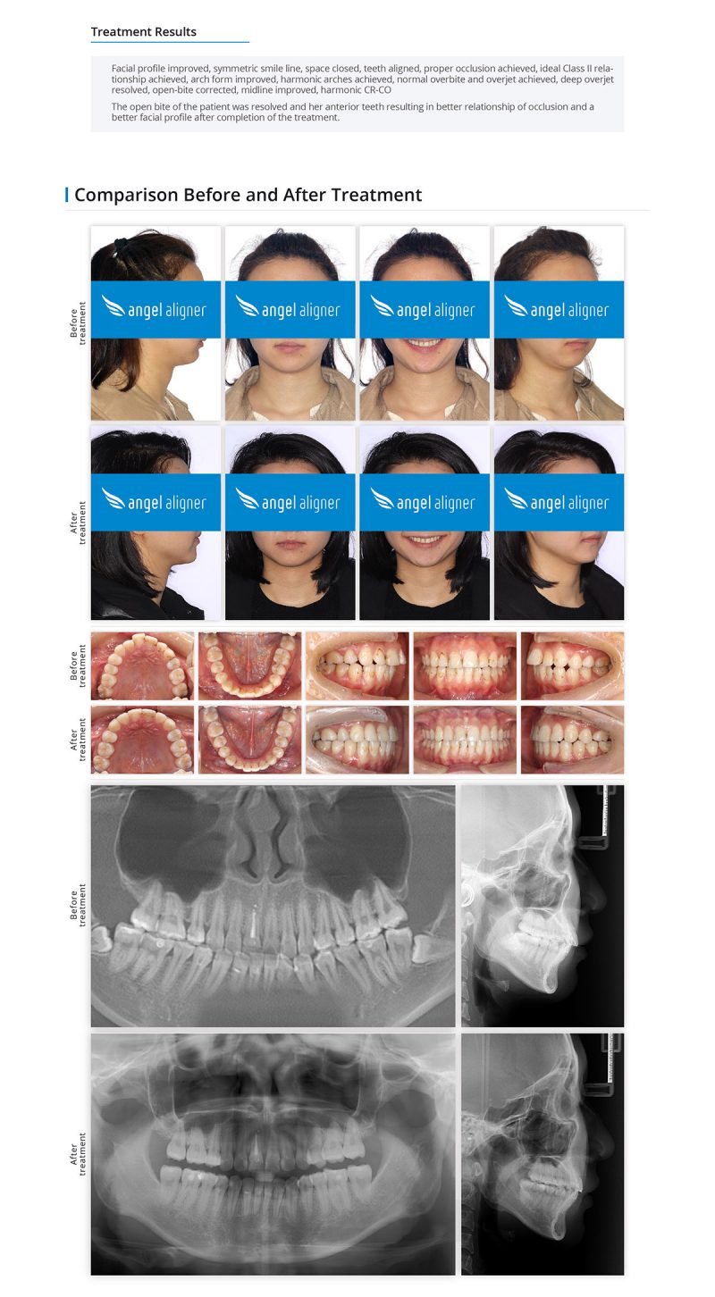 Case Study – Angel Aligner